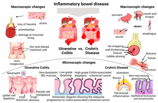 Evaluation of Disease Activity in Inflammatory Bowel Disease ...