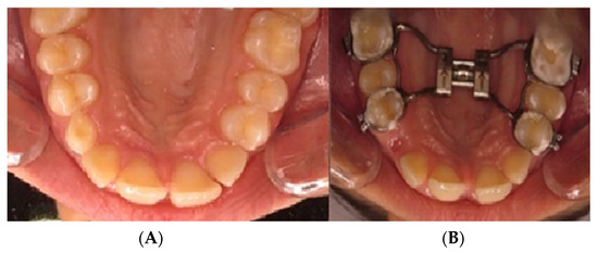A Retrospective Histological Study on Palatal and Gingival Mucosa ...