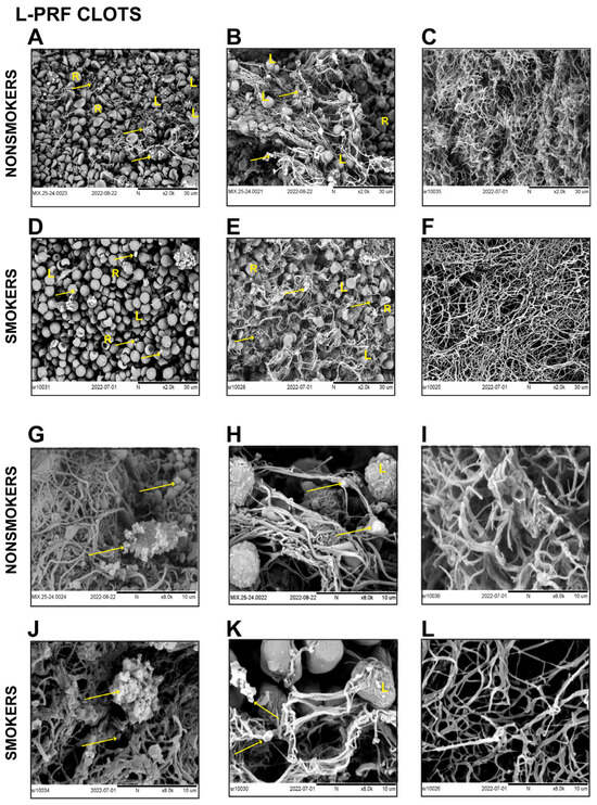 Leukocyte- and Platelet-Rich Fibrin (L-PRF) Obtained from Smokers and ...