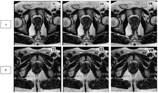 Inter-Rater Variability of Prostate Lesion Segmentation on ...