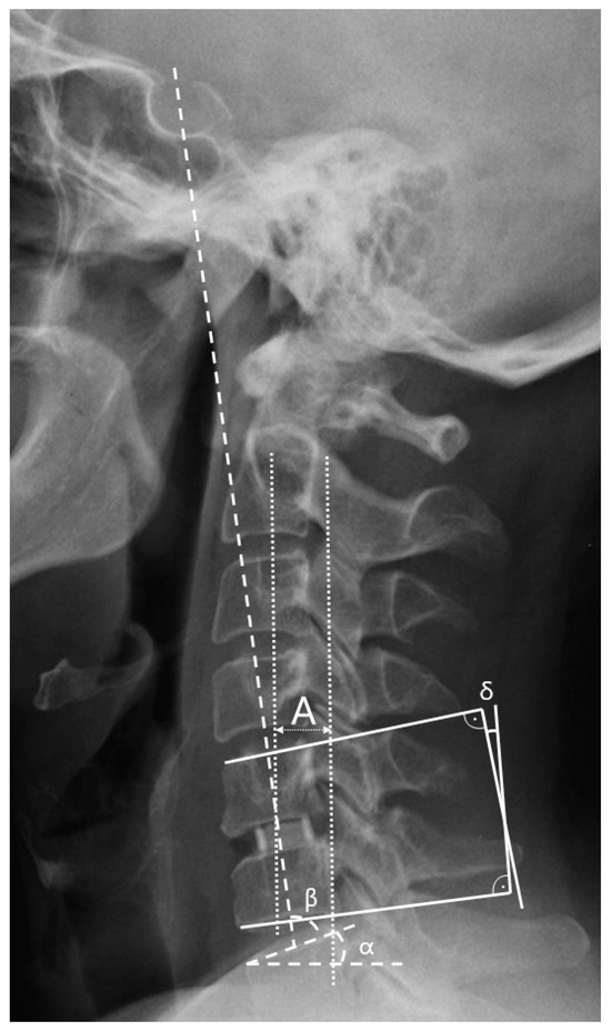 Cervical Sagittal Balance: Impact on Clinical Outcomes and Subsidence ...