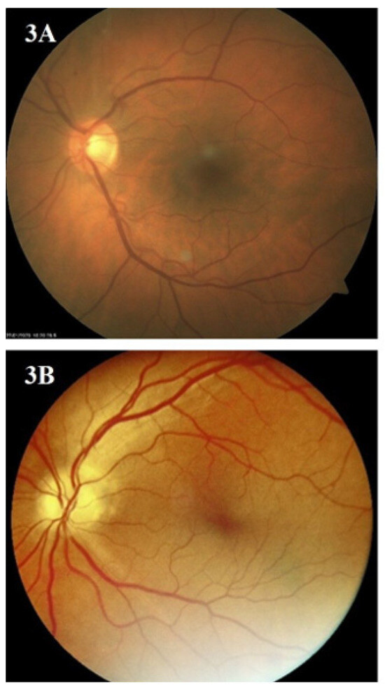 Diagnostic Accuracy of Hand-Held Fundus Camera and Artificial ...