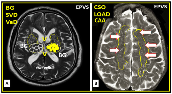 A Closer Look at the Perivascular Unit in the Development of Enlarged ...