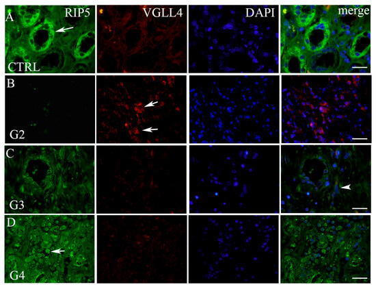 Clinical Significance and Expression Pattern of RIP5 and VGLL4 in Clear ...