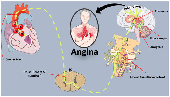 Silent Myocardial Ischemia: From Pathophysiology to Diagnosis and Treatment