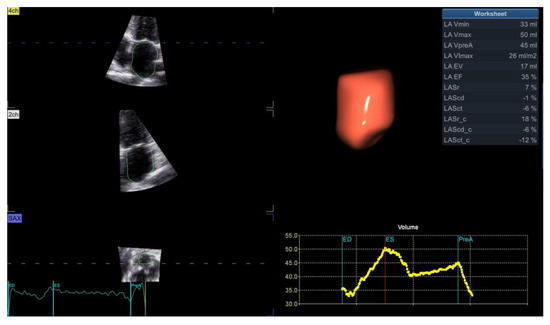 Three-Dimensional Combined Atrioventricular Coupling Index—A Novel ...