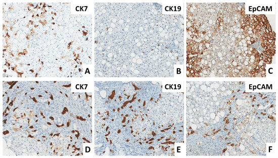 Quantitative Evaluation by Digital Pathology of Immunohistochemical Expression of CK7, CK19, and ...