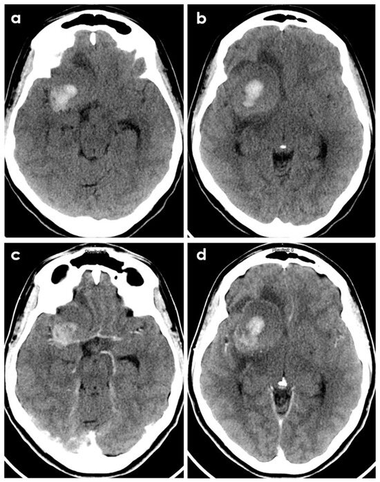 The Hemorrhagic Side of Primary Angiitis of the Central Nervous System ...