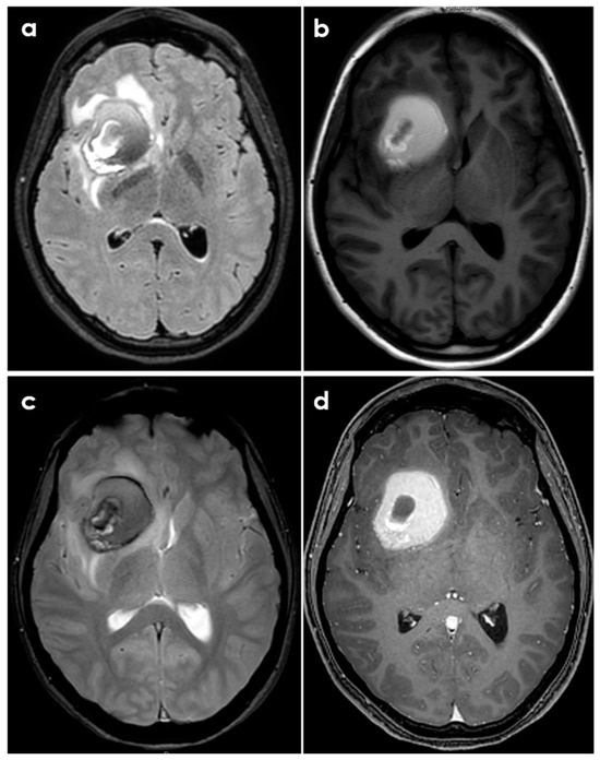 The Hemorrhagic Side of Primary Angiitis of the Central Nervous System ...