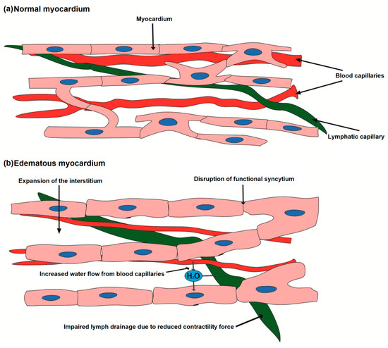 Mechanisms of Myocardial Edema Development in CVD Pathophysiology