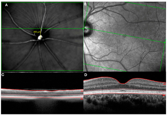 OCT Imaging in Murine Models of Alzheimer’s Disease in a Systematic ...