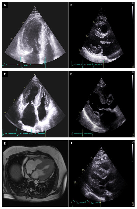 Role of Genetics in Diagnosis and Management of Hypertrophic ...
