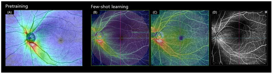 Diagnosis of Glaucoma Based on Few-Shot Learning with Wide-Field ...