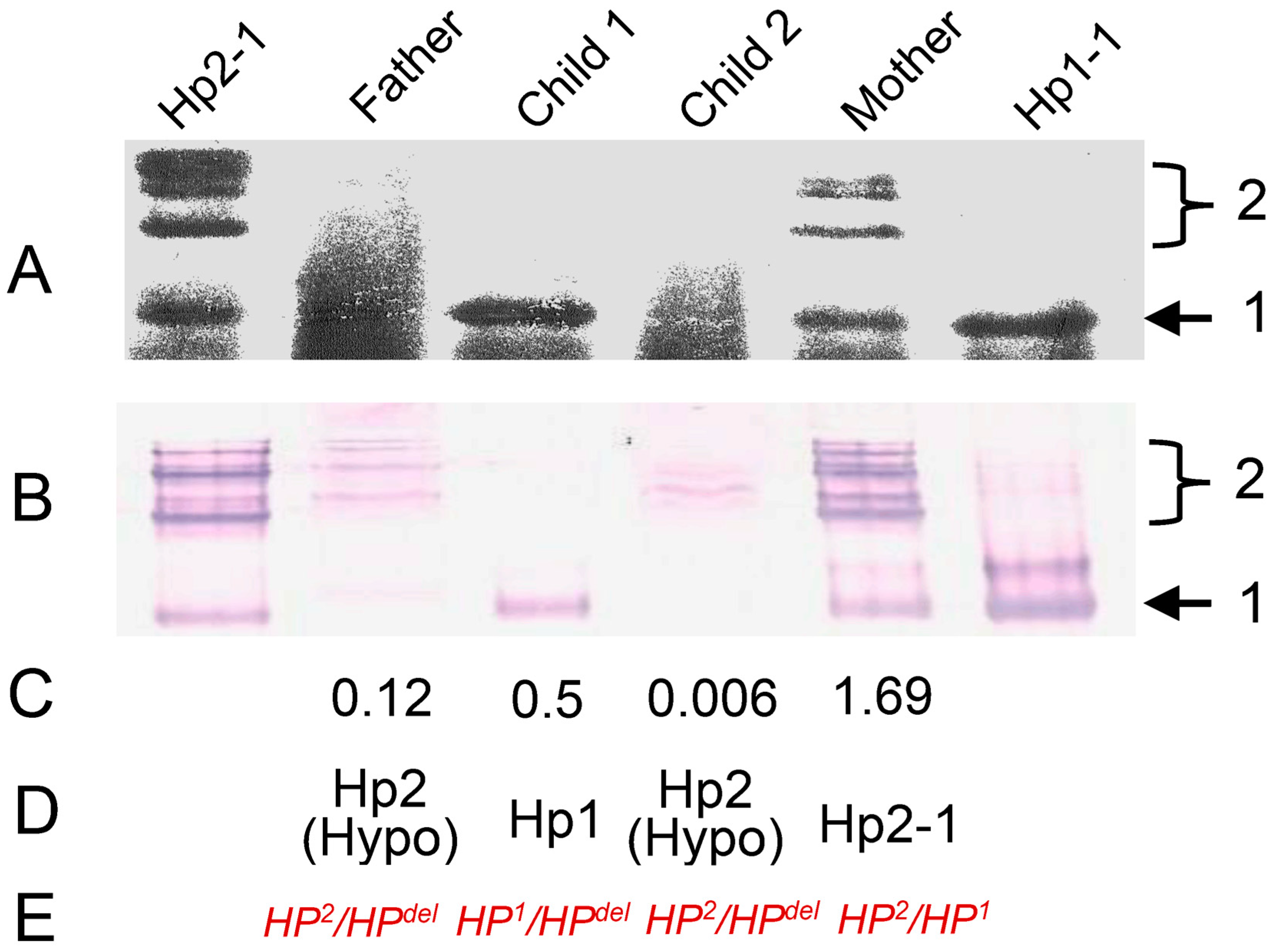 Identification and Diagnosis of Complete Haptoglobin Gene Deletion, One ...