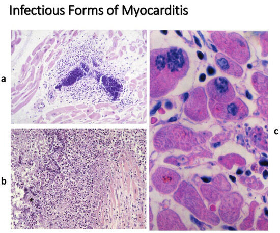 Storytelling of Myocarditis
