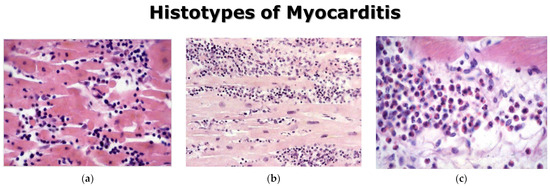 Storytelling of Myocarditis