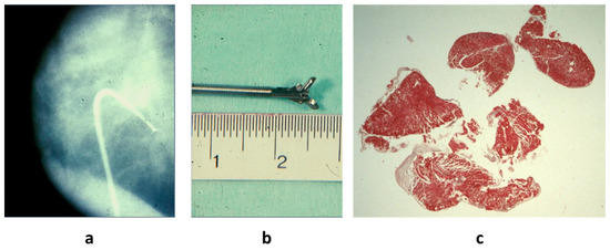 Storytelling of Myocarditis