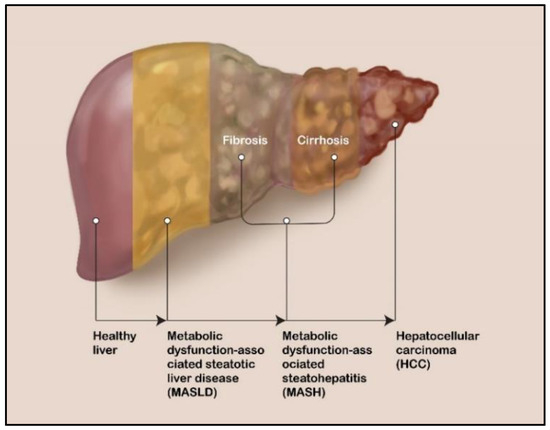 Namodenoson at the Crossroad of Metabolic Dysfunction-Associated ...