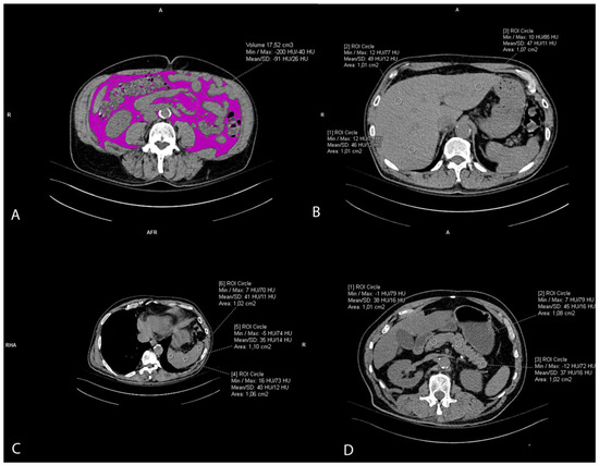 Does the Location of Fat Accumulation Affect the Degree of Aortic and ...