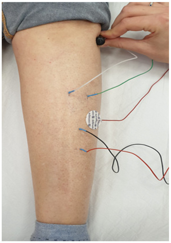 Electrophysiological Screening to Assess Foot Drop Syndrome in Severe ...
