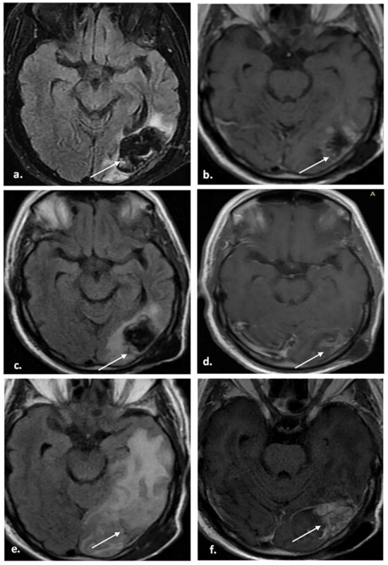 Validating Brain Tumor Reporting and Data System (BT-RADS) as a ...