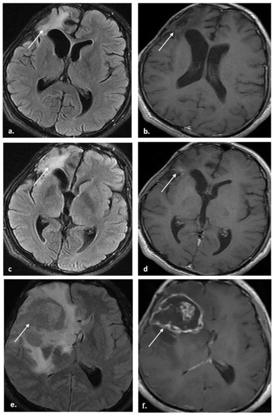 Validating Brain Tumor Reporting and Data System (BT-RADS) as a ...