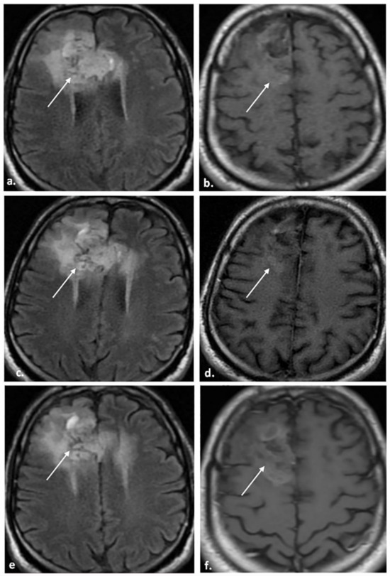 Validating Brain Tumor Reporting and Data System (BT-RADS) as a ...