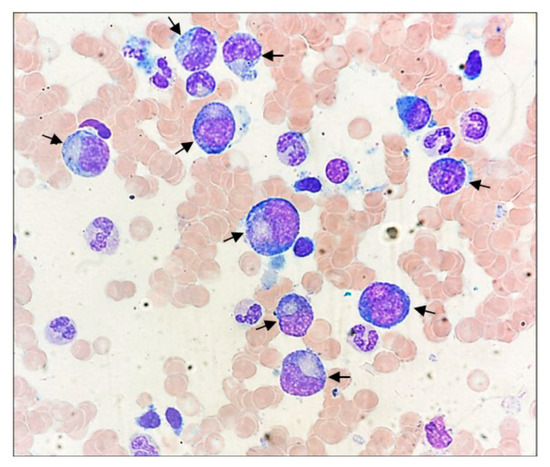 T-Large Granular Lymphocytic Leukemia with Hepatosplenic T-Cell ...