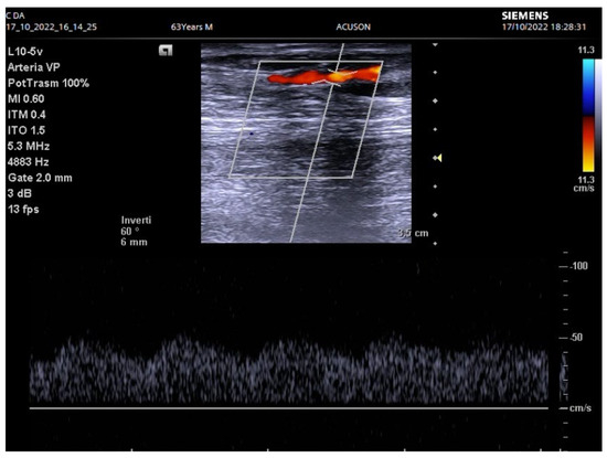 Improved Ultrasound-Guided Balloon-Assisted Maturation Angioplasty ...