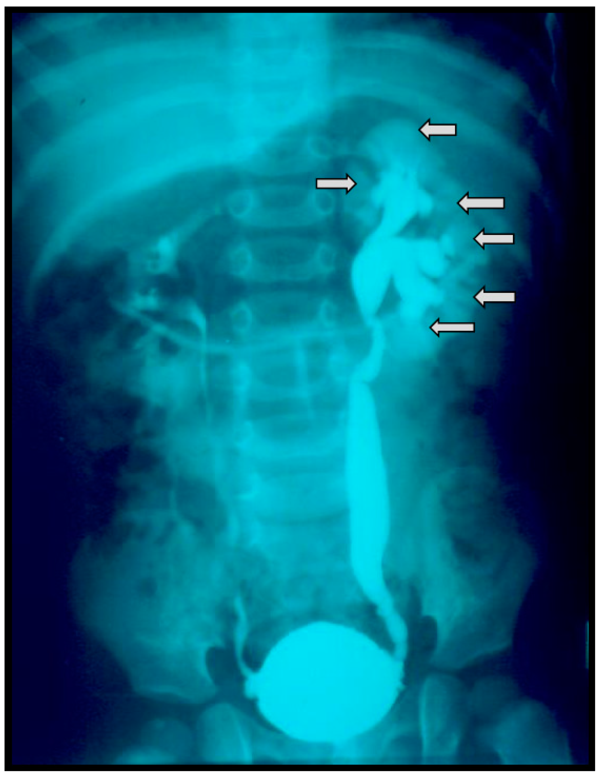 The Intrarenal Reflux Diagnosed by Contrast-Enhanced Voiding ...