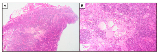 Tacrolimus Treatment for TAFRO Syndrome