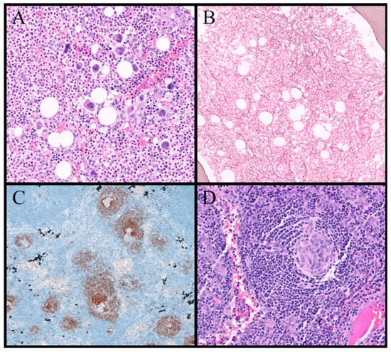 Unraveling TAFRO Syndrome: An In-Depth Look at the Pathophysiology ...