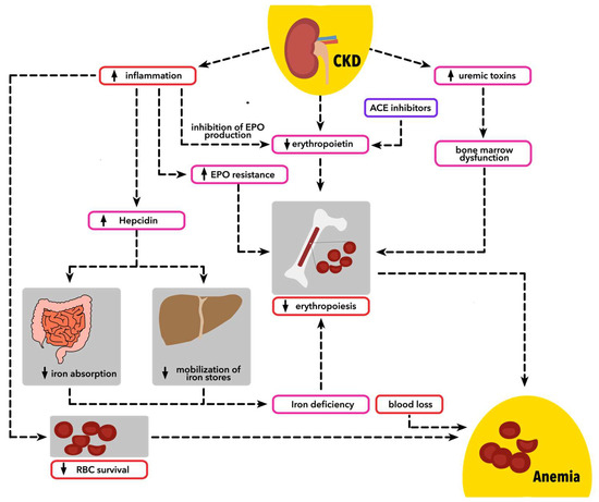 Anemia of Chronic Kidney Disease—A Narrative Review of Its Pathophysiology, Diagnosis, and ...