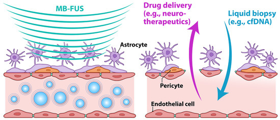 Microbubble-Enhanced Focused Ultrasound for Infiltrating Gliomas