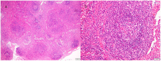 TAFRO Syndrome: Guidance for Managing Patients Presenting ...