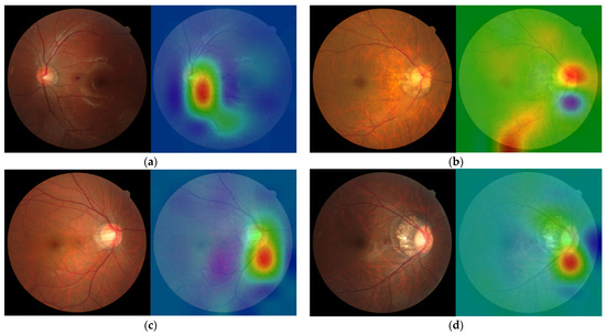Biomedicines | Free Full-Text | Deep Learning Evaluation of Glaucoma ...