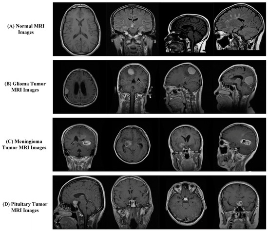 Brain Tumor MRI Classification Using a Novel Deep Residual and Regional CNN