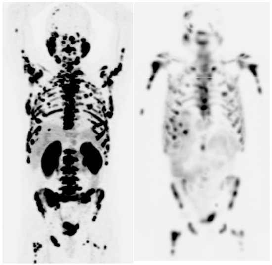 Lutetium-177-Prostate-Specific Membrane Antigen Radioligand Therapy ...