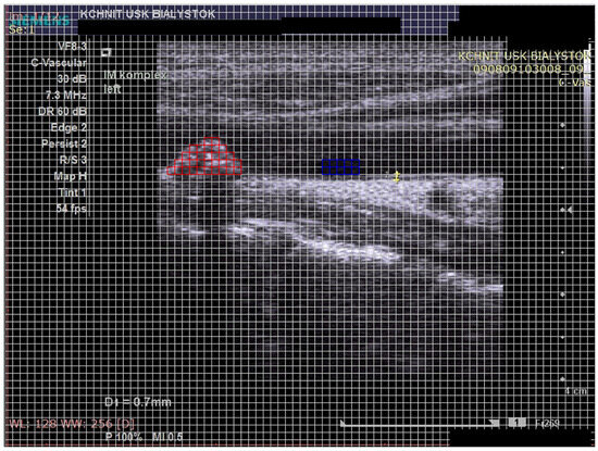 Gray-Scale Median in Patients with Symptomatic and Asymptomatic Carotid ...