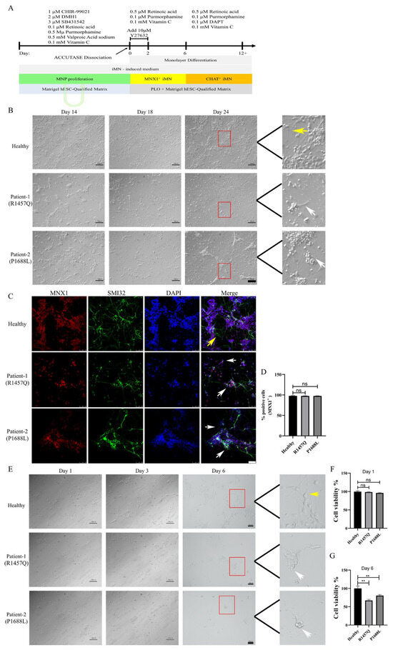 KIF1A, R1457Q, and P1688L Mutations Induce Protein Abnormal Aggregation ...