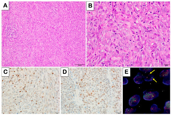 NSD3::NUTM1 Fusion Sarcoma Mimicking Malignant Peripheral Nerve Sheath ...