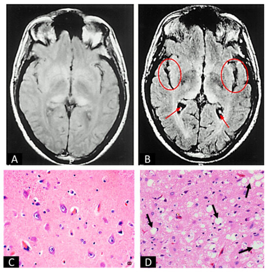 Perspectives on CRISPR Genome Editing to Prevent Prion Diseases in High ...