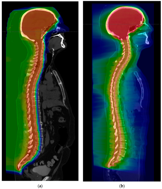 Radiotherapy and Systemic Treatment for Leptomeningeal Disease