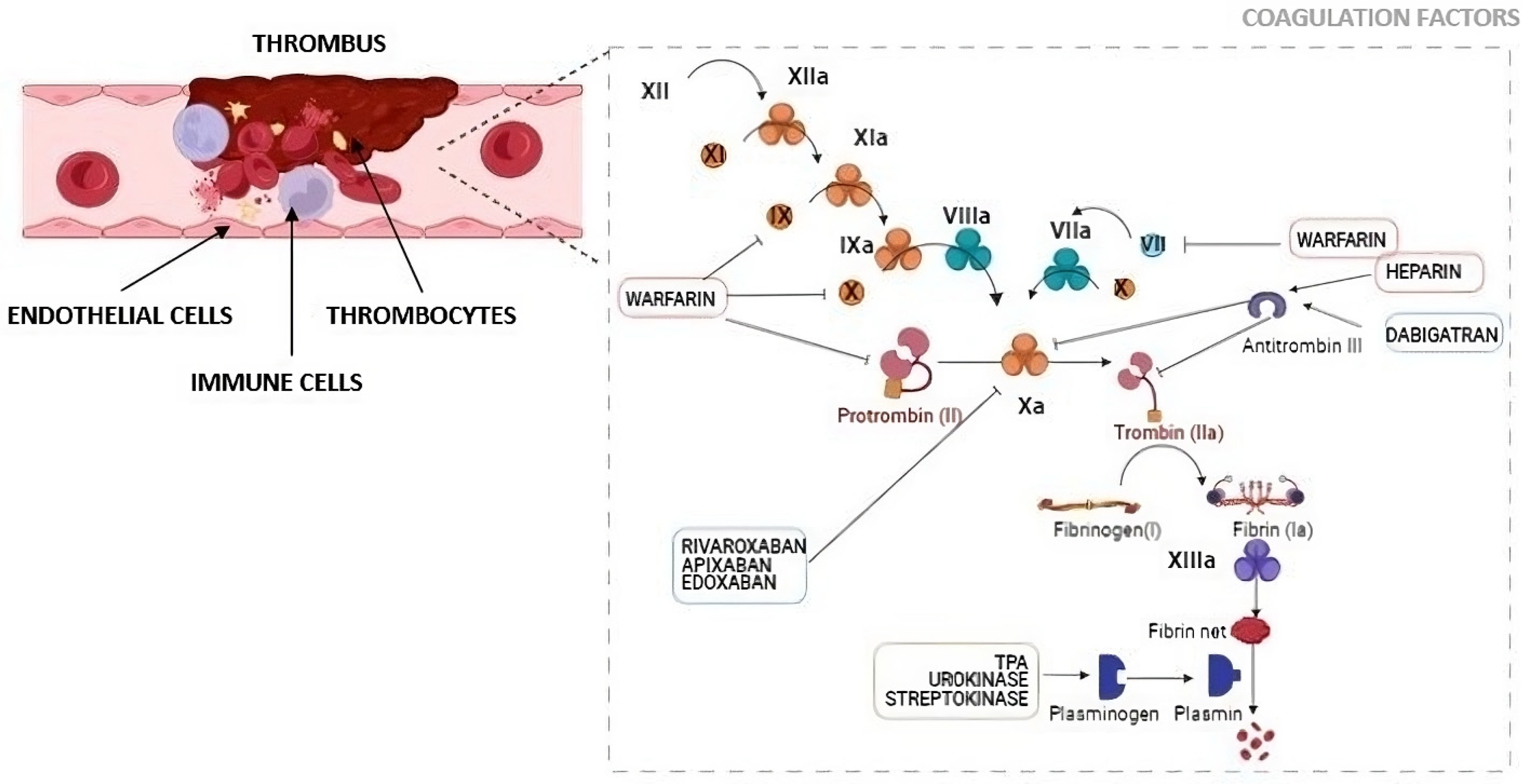 Decoding Pulmonary Embolism: Pathophysiology, Diagnosis, and Treatment