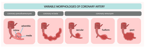 Coronary Artery Aneurysm or Ectasia as a Form of Coronary Artery ...
