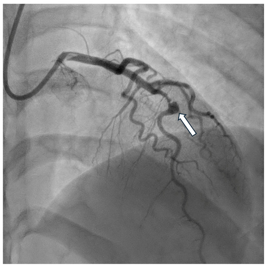 Coronary Artery Aneurysm or Ectasia as a Form of Coronary Artery ...