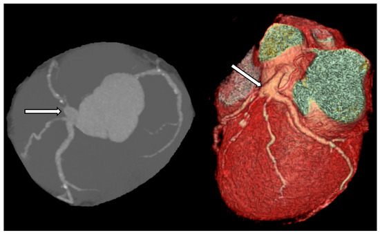 Coronary Artery Aneurysm or Ectasia as a Form of Coronary Artery ...