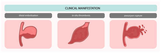 Coronary Artery Aneurysm or Ectasia as a Form of Coronary Artery ...