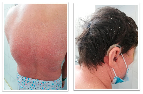 Navigating Surgical Challenges: Managing Juvenile Glaucoma in a Patient ...