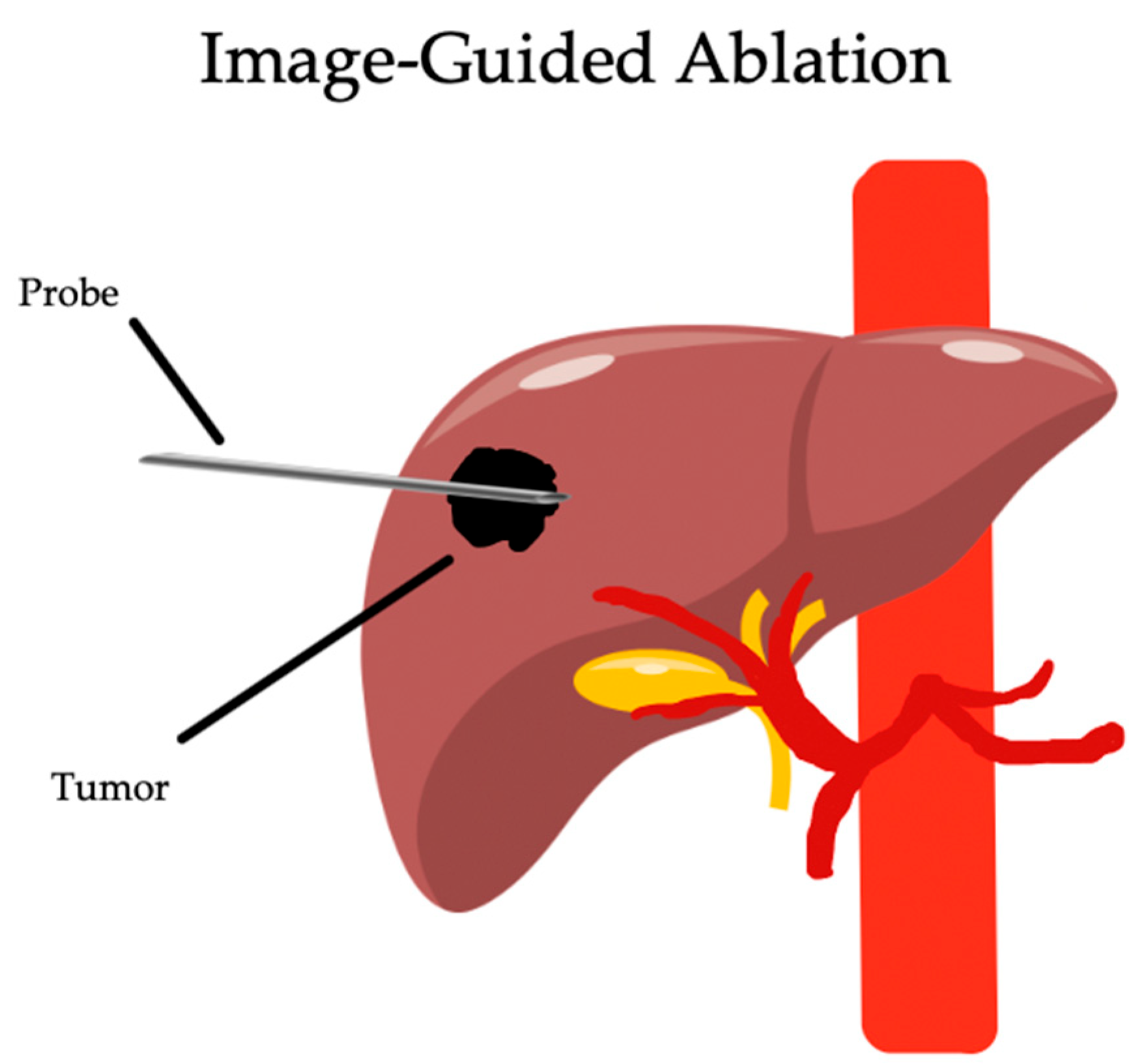 Locoregional Therapies for Hepatocellular Carcinoma in Patients with ...